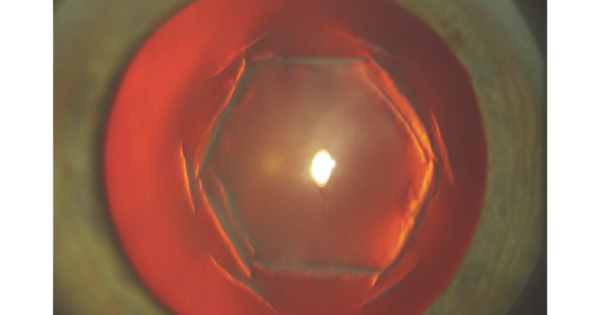 CRSToday | Poor Vision After Hexagonal Keratotomy
