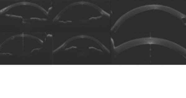 CRSToday | Deepfake OCT Imaging